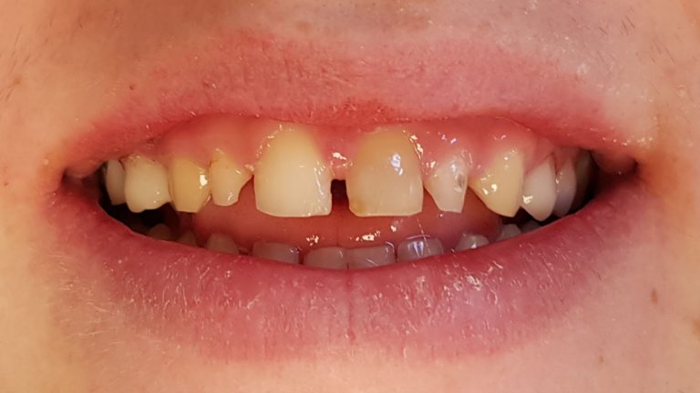 Portfolio - Restyle Your Smile