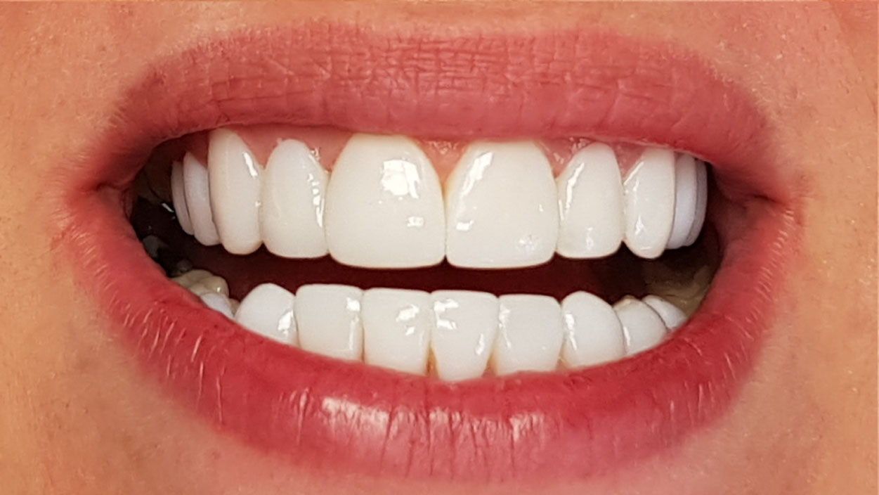 Portfolio - Restyle Your Smile